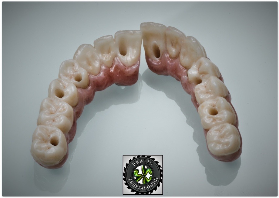 Implants | Praxis Dental Labor